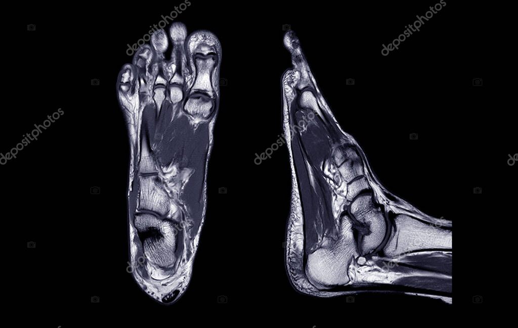 "Manetic resonance imaging of foot or MRI FOOT PDW axial, Coronal and ...