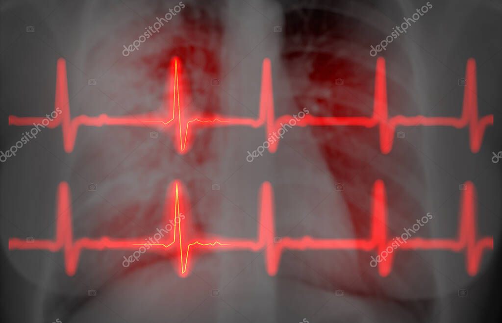 "CHEST X-ray with EKG 3D rendering image for diagnosis of vessel ...
