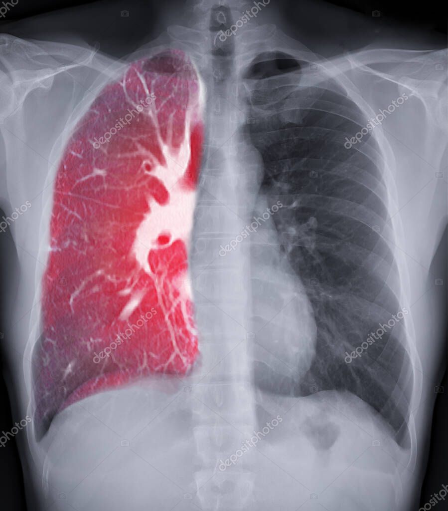 "Imagen de radiografía de tórax con TC CHEST para diagnóstico de detección TB, tuberculosis y ...