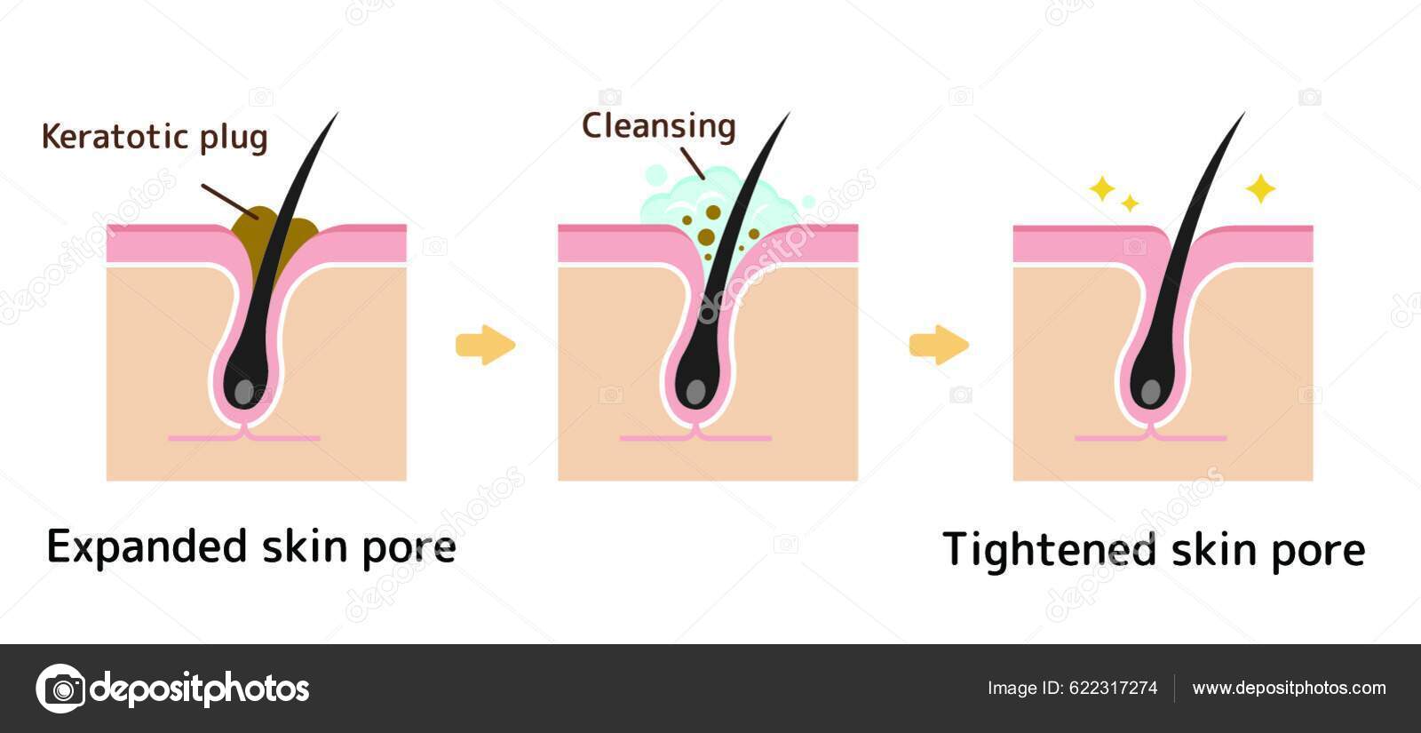 Structure Illustration Pores Clear Keratotic Plug Whiteheads Blackheads ...
