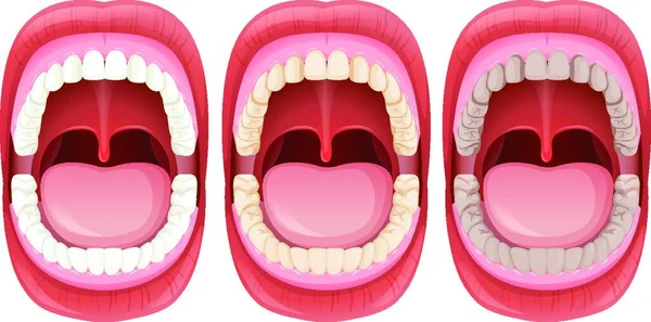 Anatomi Mulut Manusia Ulcers Vektor Stok oleh ©YAY_Images 622798554