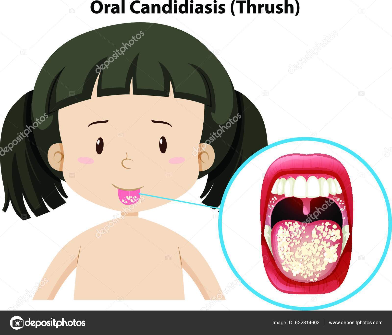 Oral Candidiasis Thursh Girl Stock Vector by ©YAY_Images 622814602