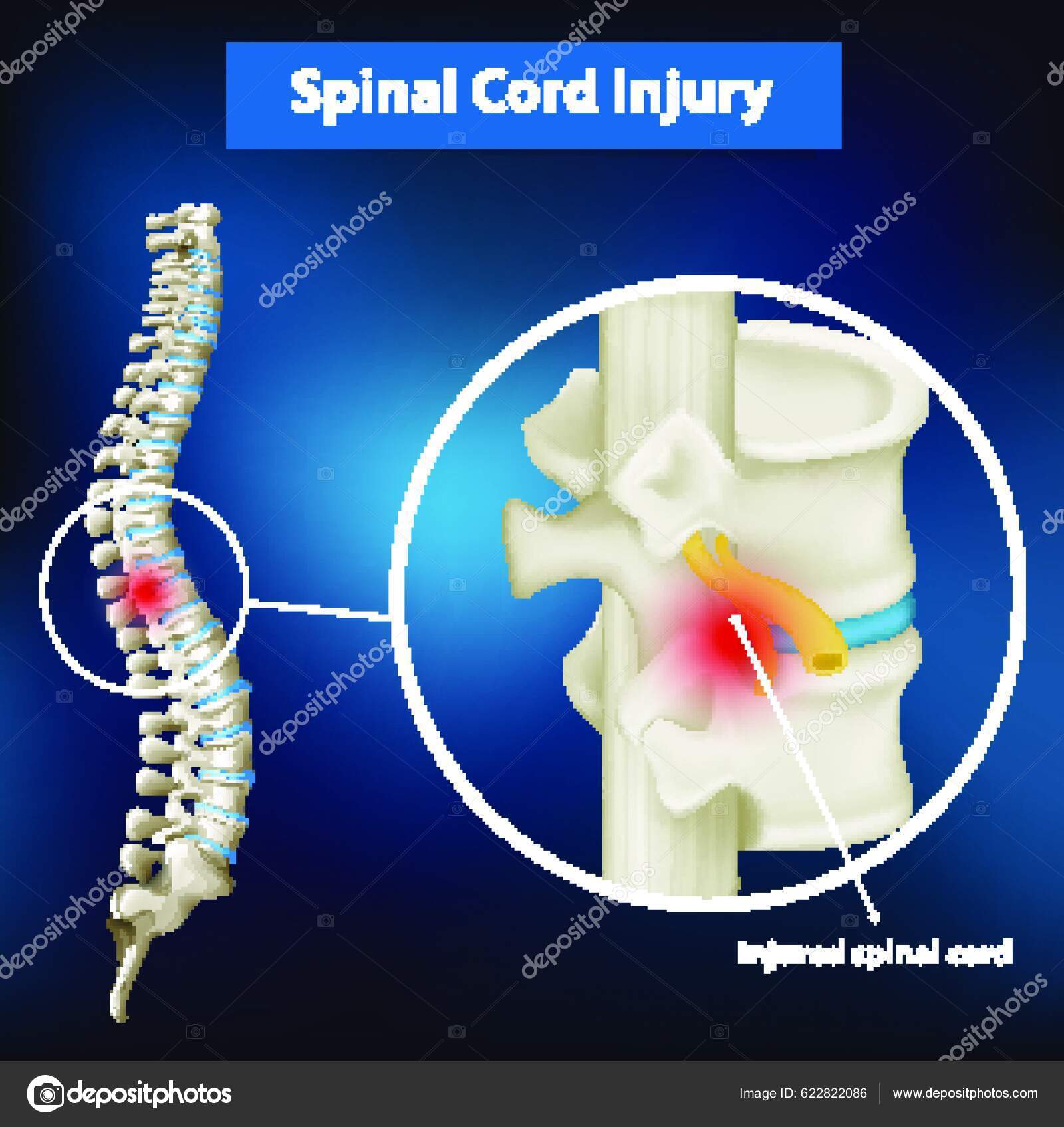 Diagram Showing Spinal Cord Injury Stock Vector by ©YAY_Images 622822086 Diagram Showing Spinal Cord Injury Stock Vector by ©YAY_Images 622822086
