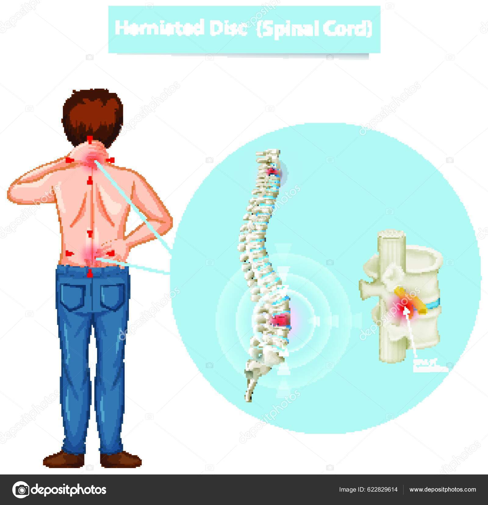 Diagram Showing Herniated Disc Stock Illustration by ©YAY_Images #622829614