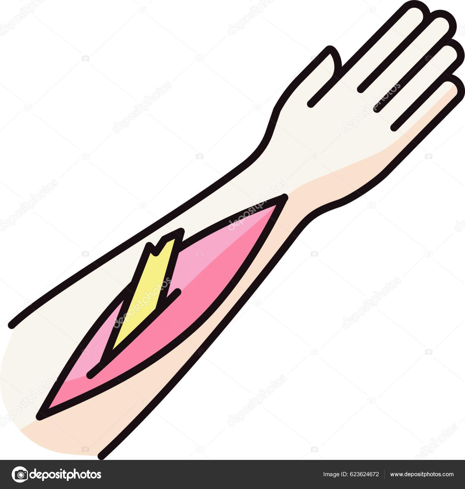 Open Bone Fracture Rgb Color Icon Bone Sticking Out Human Stock Vector ...