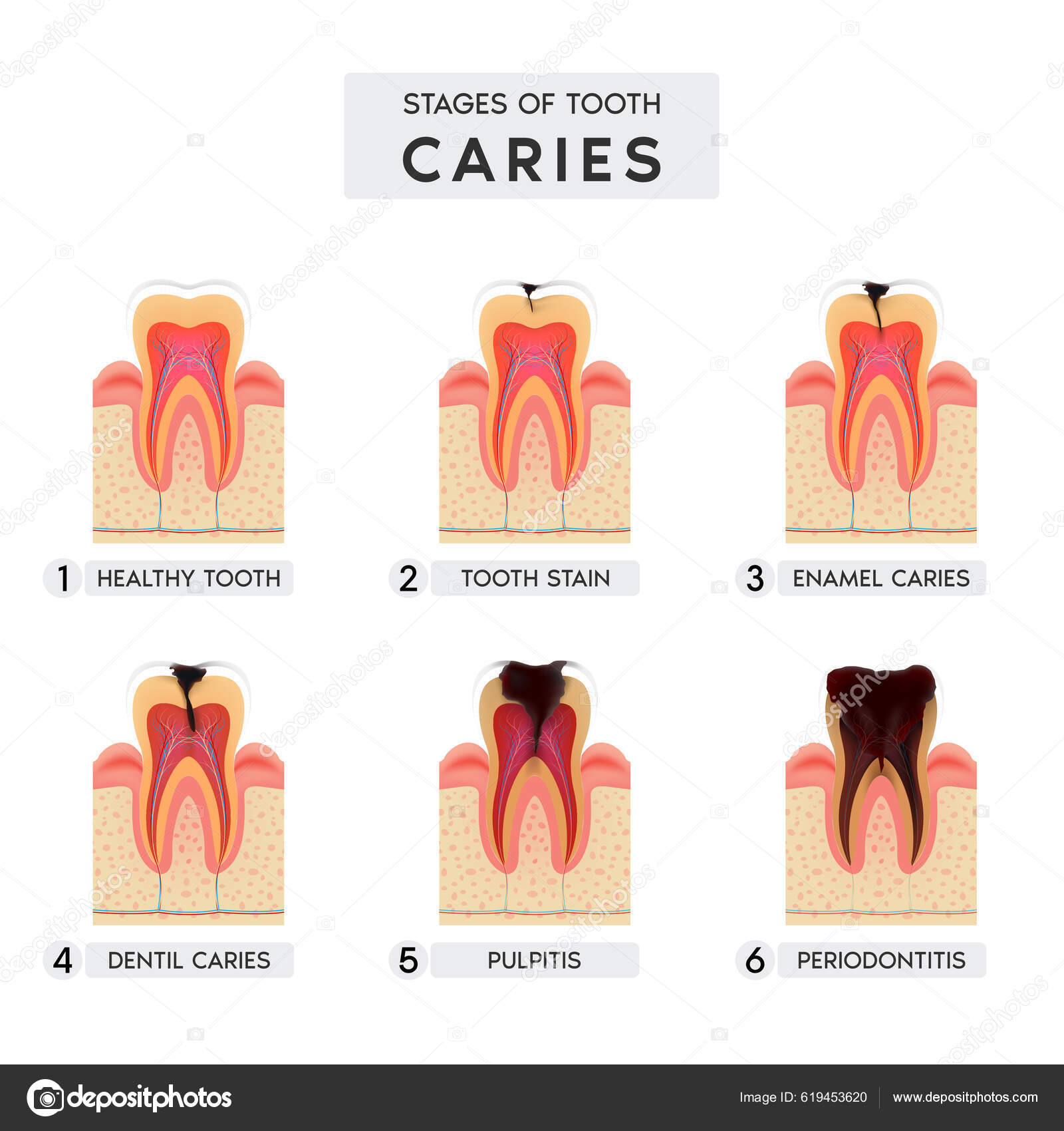 Kariesstruktur Und Progression Und Behandlung Zahnmedizinische Illustration Realistischem Stil ...