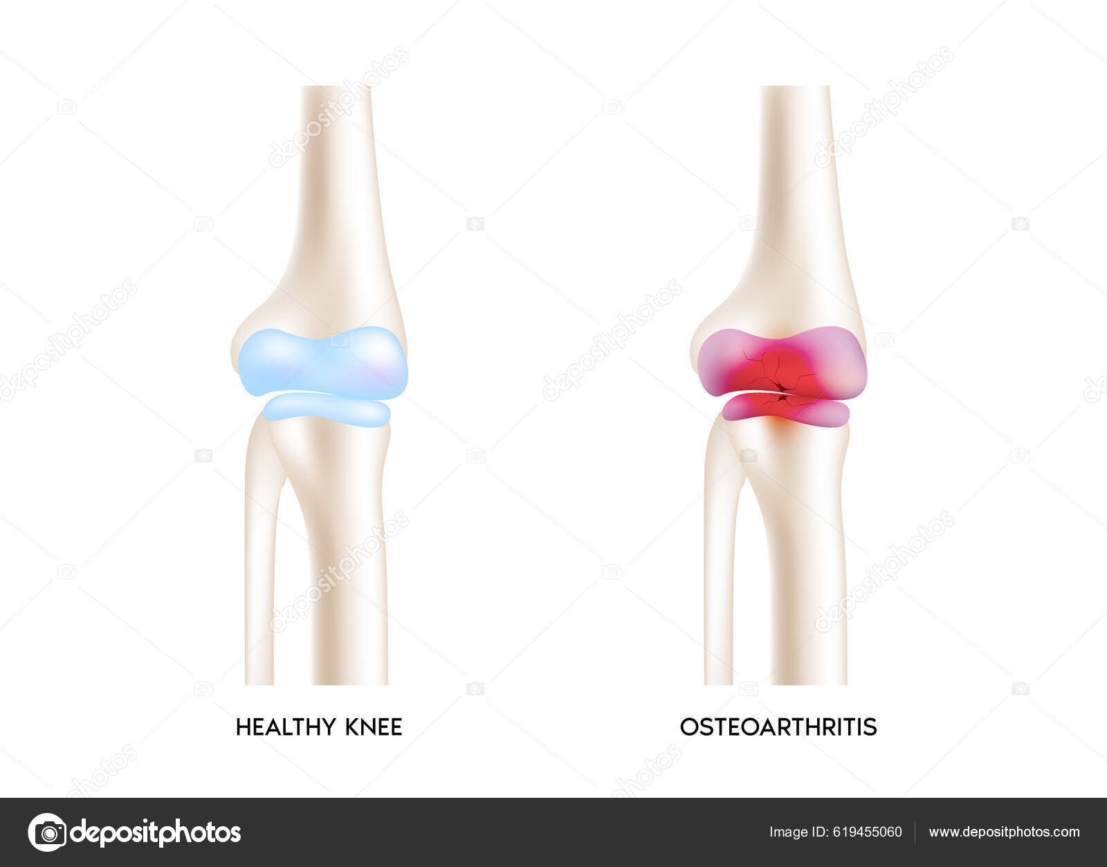 Lutut Osteoartritis Artritis Atau Penyakit Sendi Degeneratif Cartilage ...