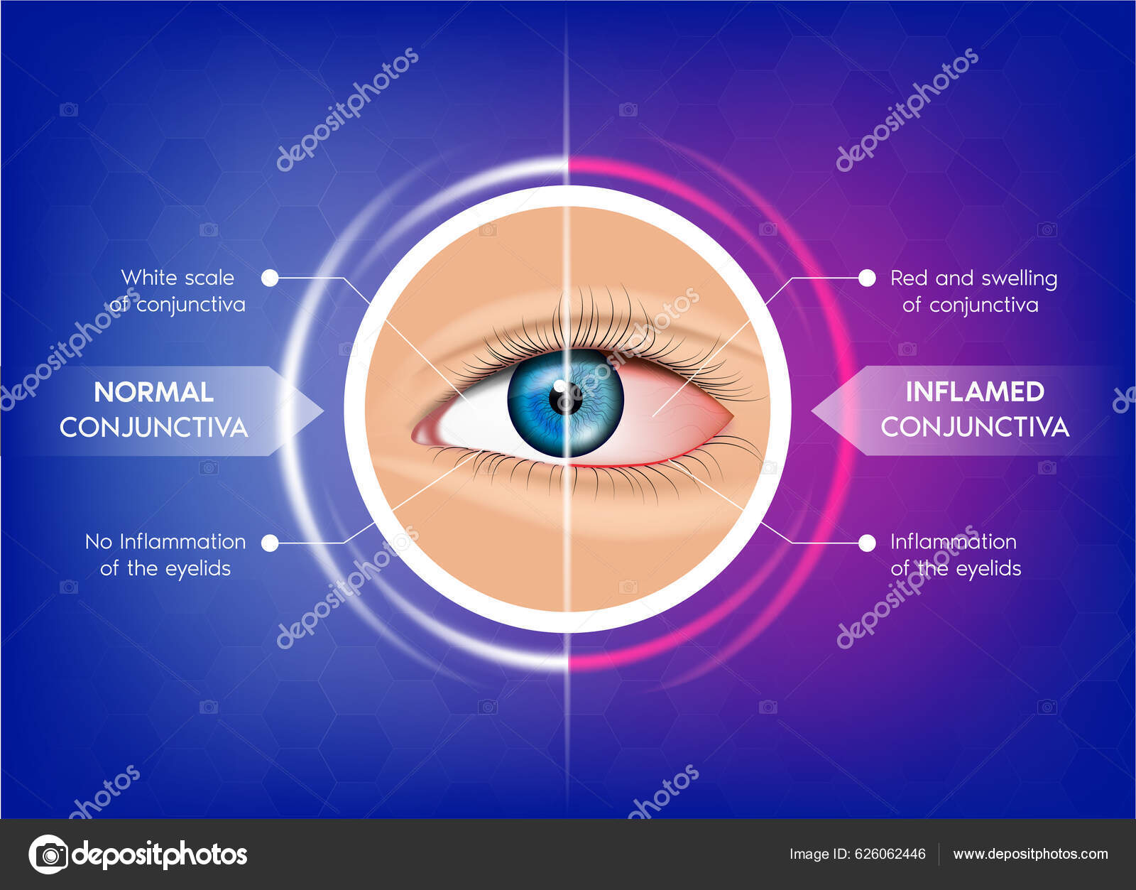 Normal Conjunctiva Conjunctivitis Healthy Eye Pink Eye Most Common Eye ...