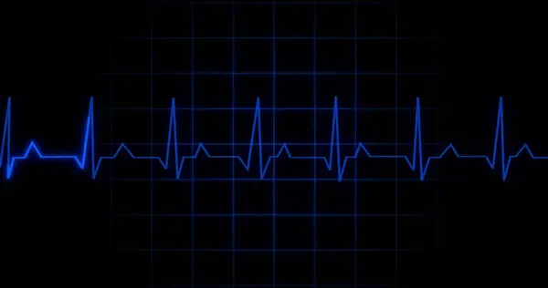 EKG Heartbeat reading animation on black background. Medical monitor ...