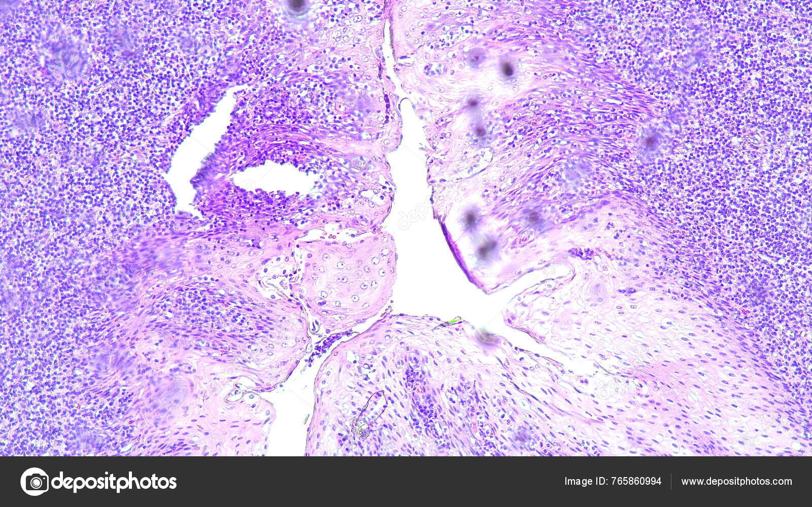 Anatomy Histology Bilateral Tonsils Parotid Human Cells Chronic ...