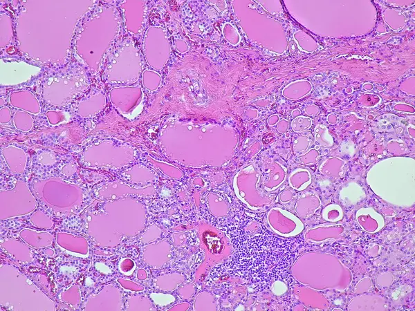 fotomicrografía de la tiroiditis de Hashimoto (tiroiditis linfocítica ...