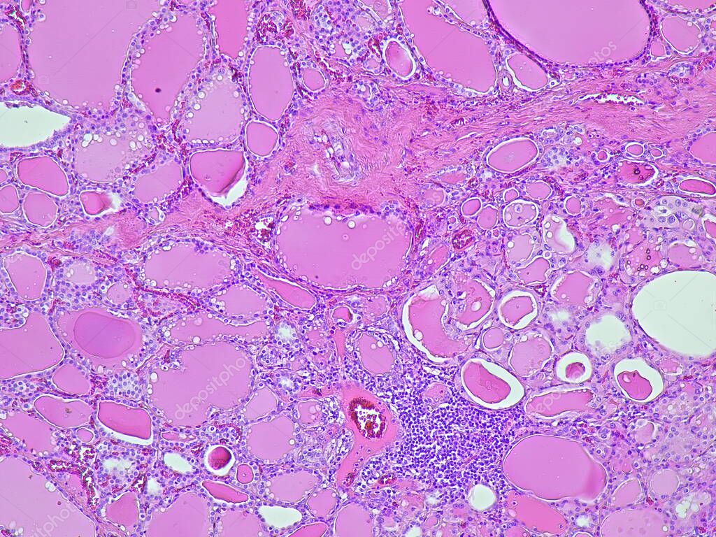fotomicrografía de la tiroiditis de Hashimoto (tiroiditis linfocítica ...