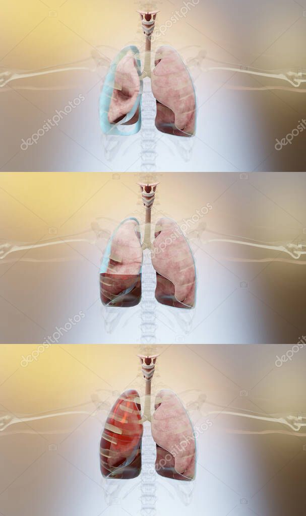 Ilustración 3d de neumotórax, hemotórax y hemopneumotórax, pulmón ...