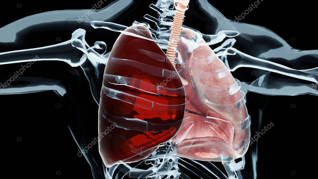 Ilustraci n 3d de hemot rax, pulm n normal versus colapsado, s ntomas de hemot rax, derrame ...