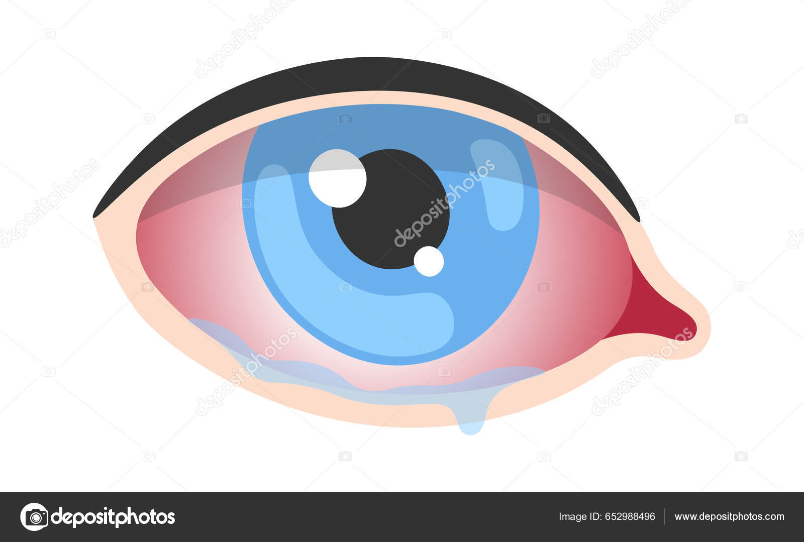 Keratitis Human Eye Disease Vector Illustration Vetor de ©Lookz 652988496