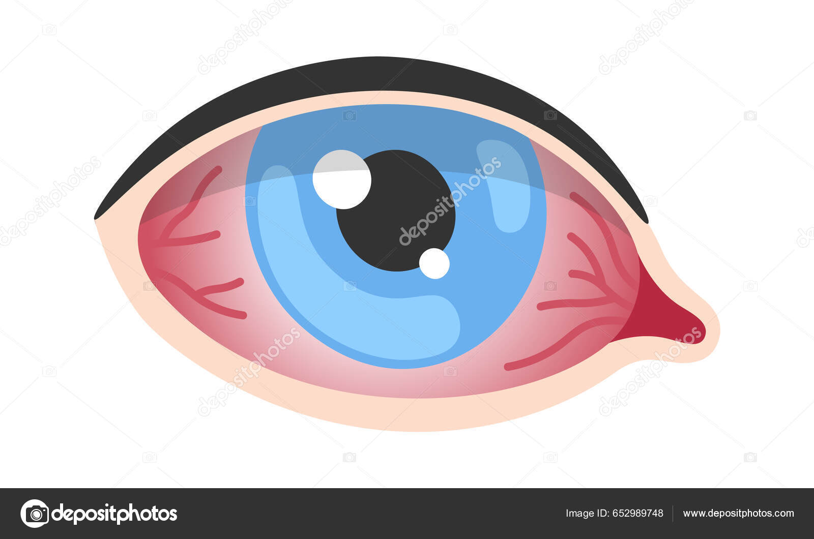 Conjuntivitis Bacteriana Enfermedad Ocular Vector Illustration Vector