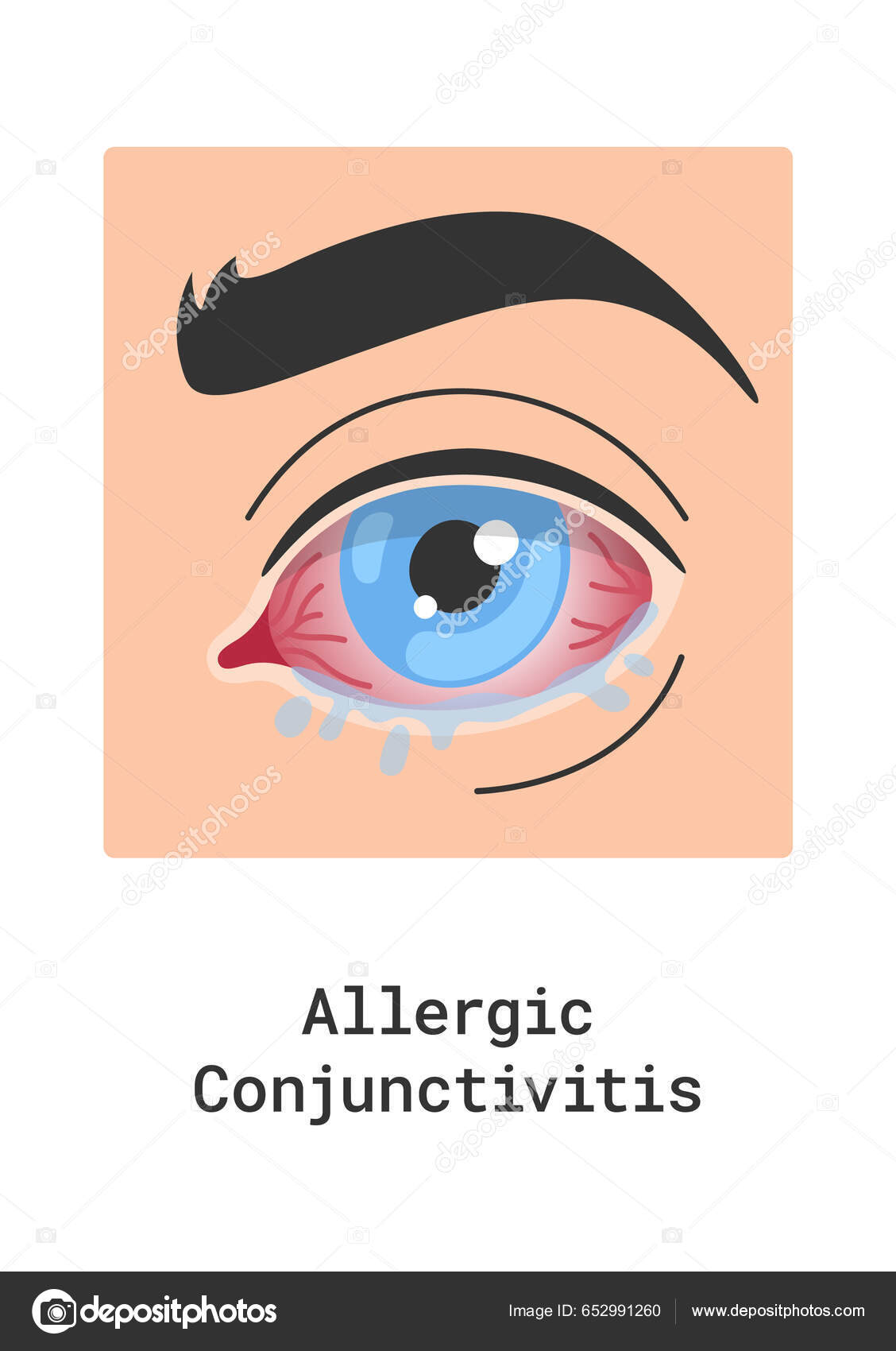 Conjuntivitis Alérgica Enfermedad Ocular Vector Ilustración Vector de ...