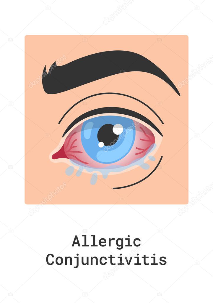 Conjuntivitis Alérgica Enfermedad Ocular Vector Ilustración Vector De
