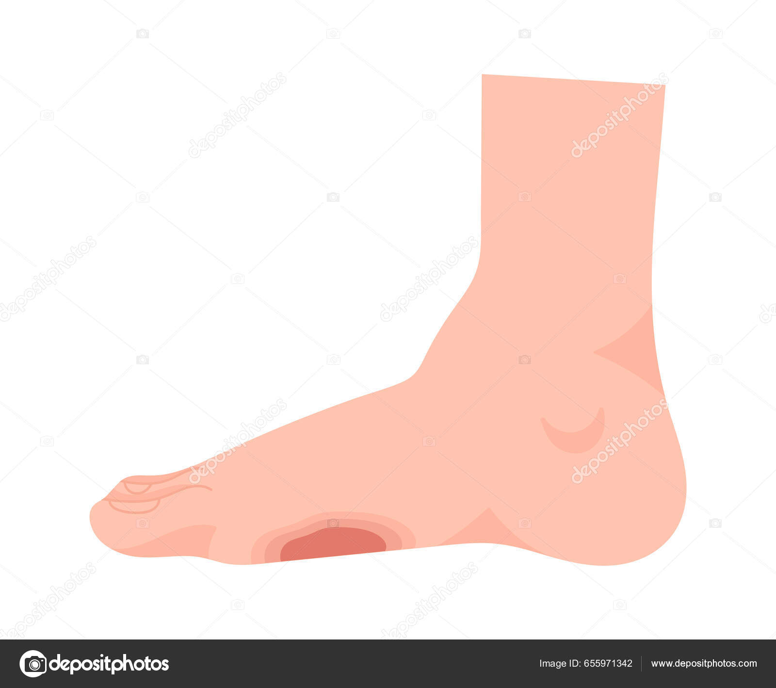 Foot Ulcer Disease Vector Illustration Stock Vector by ©Lookz 655971342