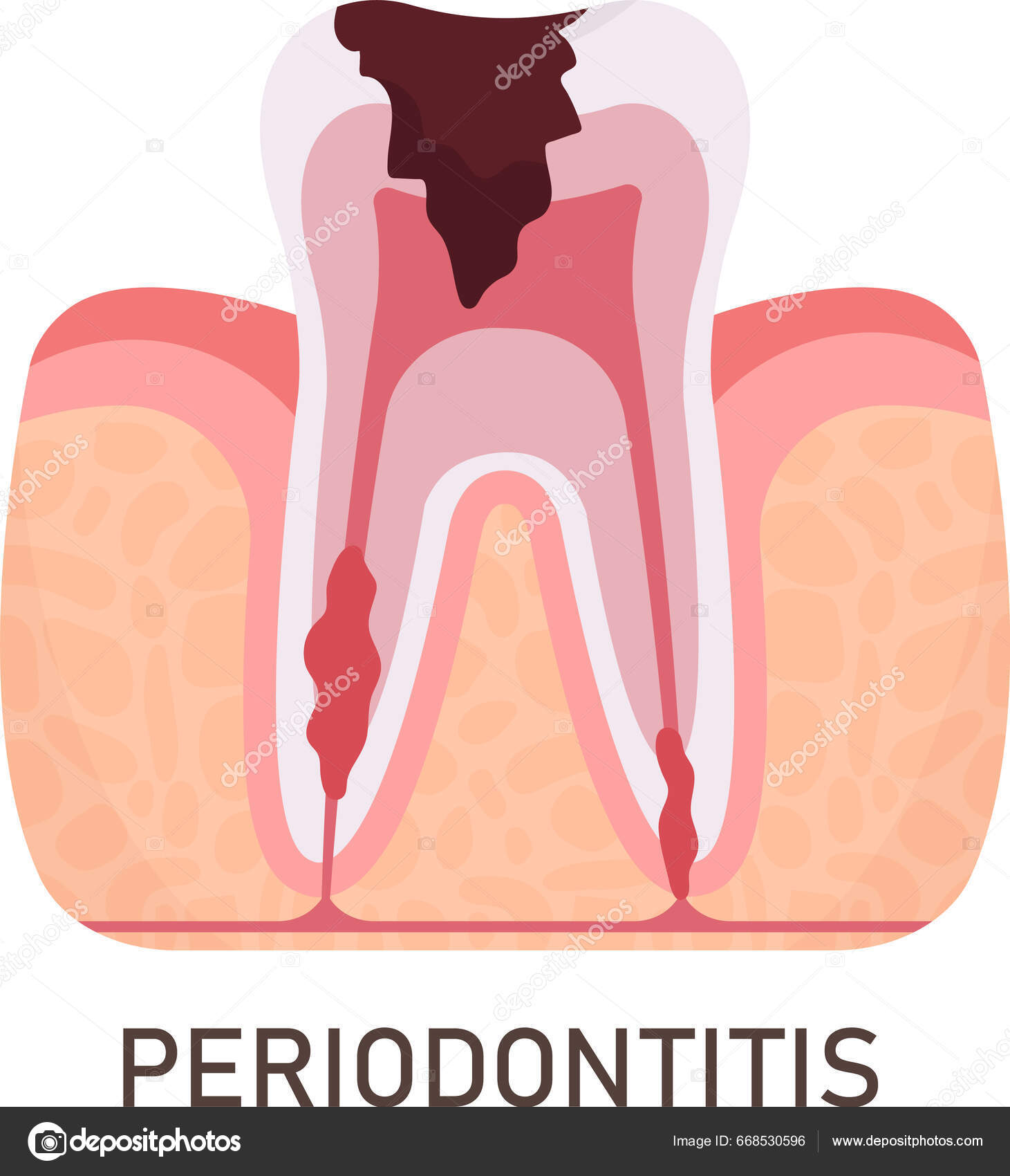 Periodontitis Tooth Problem Vector Illustration Stock Vector by ©Lookz ...