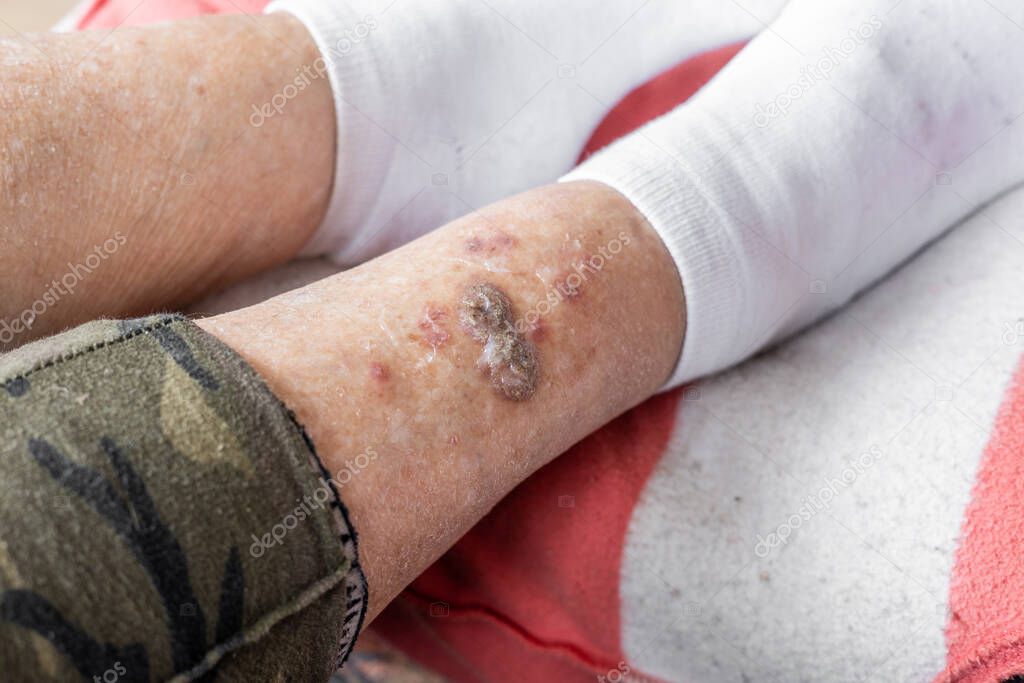 Úlceras y enfermedades de la piel, costras secas y heridas frescas en ...