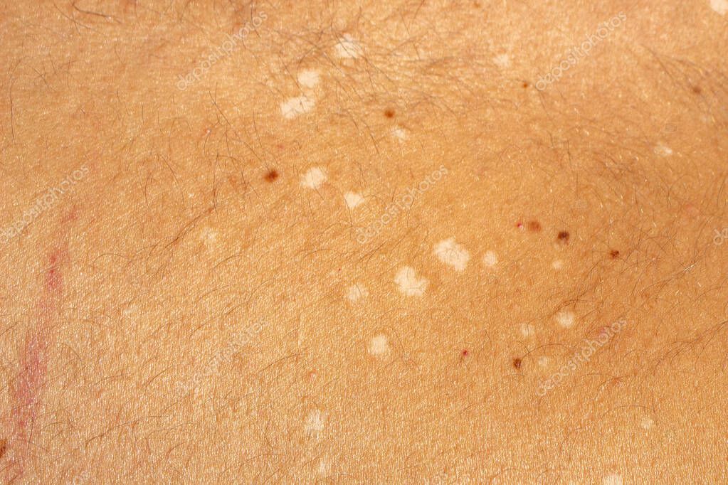 Capture la complejidad visual de la ti a versicolor, una infecci n f ngica com n de la piel, con ...