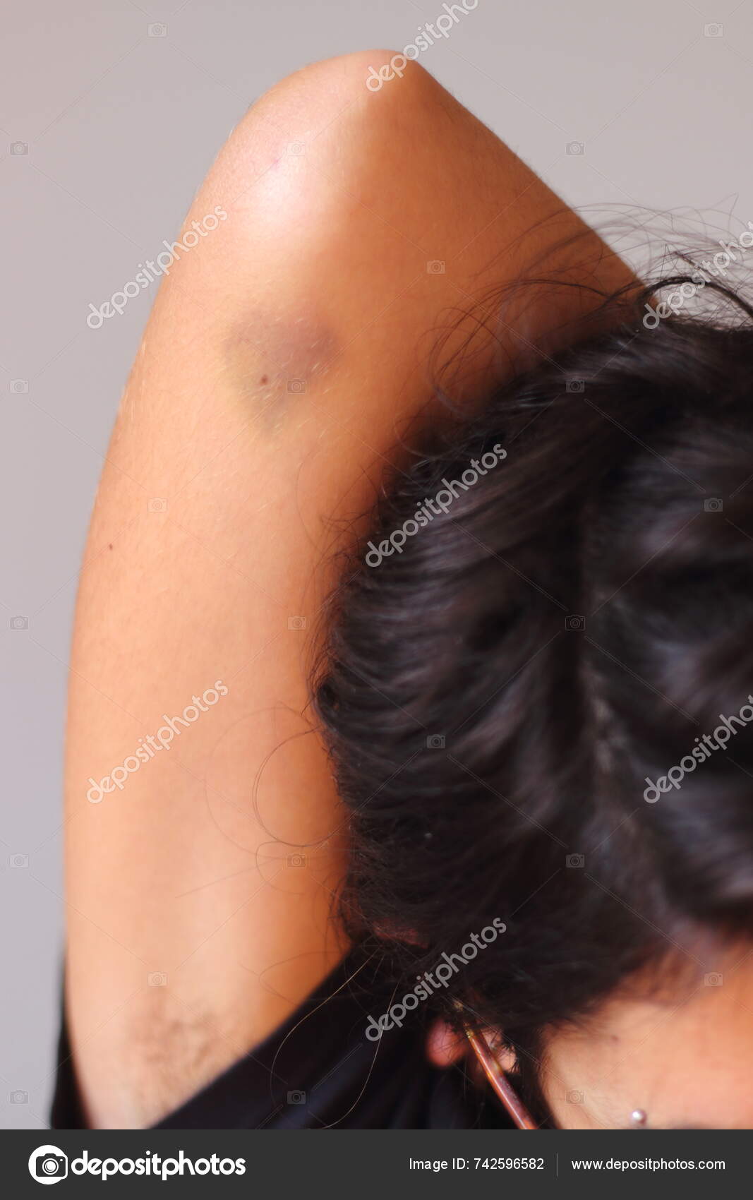 Heart Shaped Bruise Arm Young Woman Symbolizes Pain Impact Toxic ...