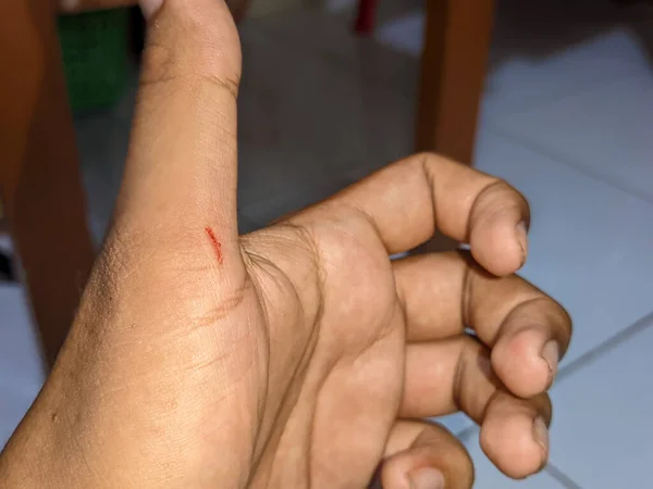 Scratch wound Stock Photos, Royalty Free Scratch wound Images ...