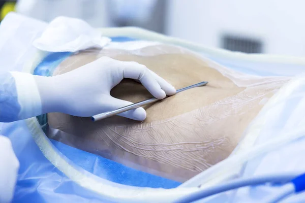 Incisiones quirúrgicas fotos de stock, imágenes de Incisiones ...