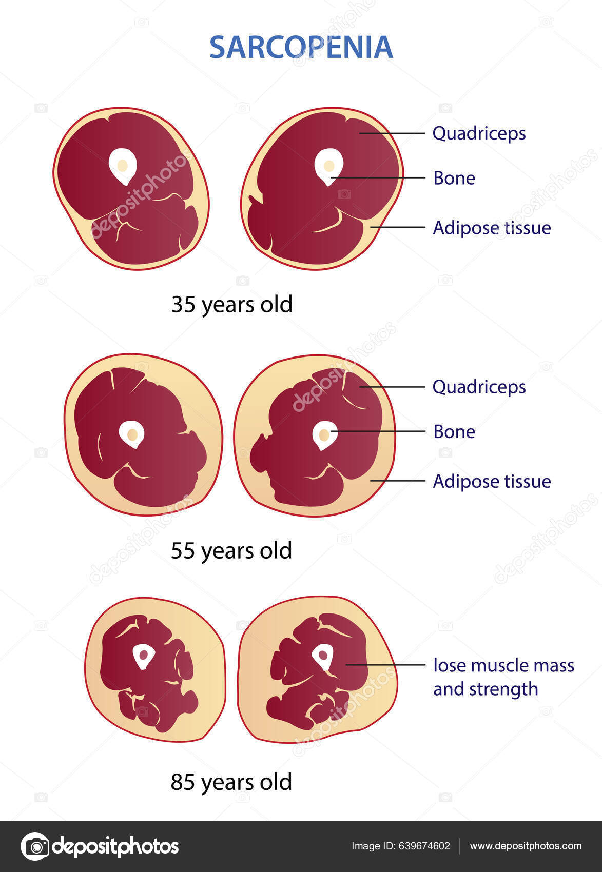 Infografía Ilustración Vectorial Sarcopenia Aislada Sobre Fondo Blanco ... Infografía Ilustración Vectorial Sarcopenia Aislada Sobre Fondo Blanco ...