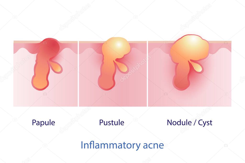 Tipos de vector inflamatorio del acné sobre fondo blanco. Pápula ...