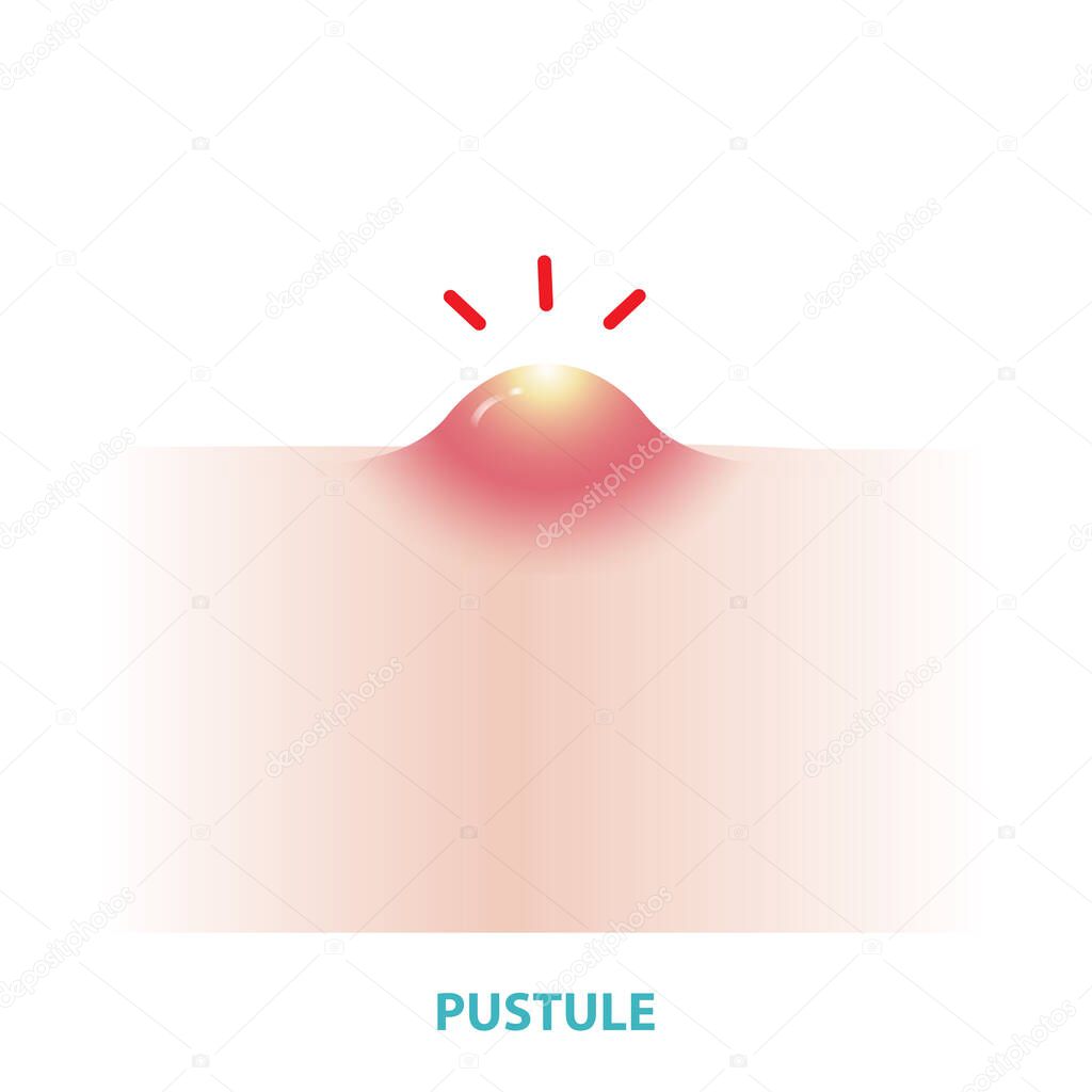 Pustule vector de acné aislado sobre fondo blanco. Formación de acné ...