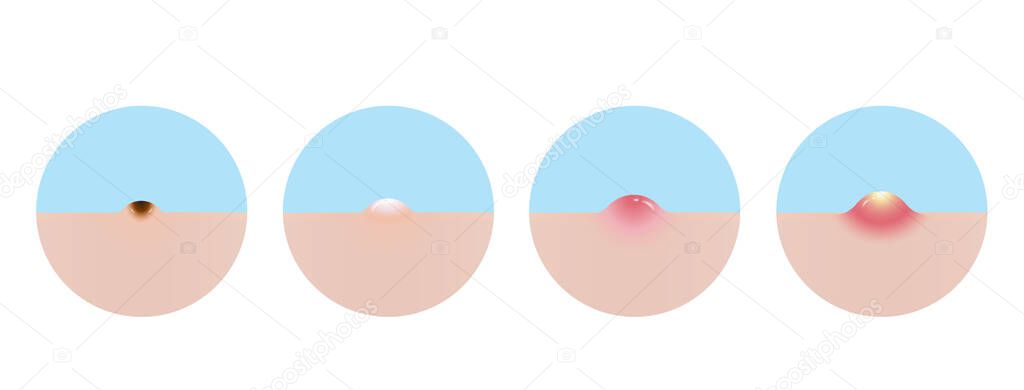 Tipos de icono de vector de acné conjunto ilustración aislada sobre ...