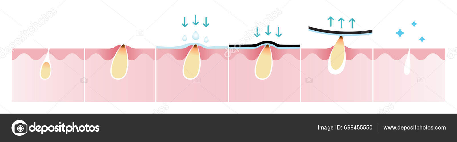 Sección Transversal Del Acné Cabeza Negra Cómo Eliminar Vector ...