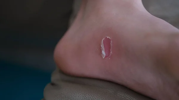 Blister on foot Stock Photos, Royalty Free Blister on foot Images ...