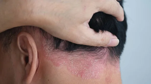 Ulcère cutané images libres de droit, photos de Ulcère cutané ...