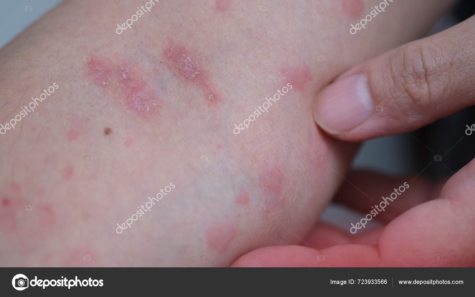 Man Hand Starting Suffering Prosiasis Severe Urticaria Hives — Stock ...
