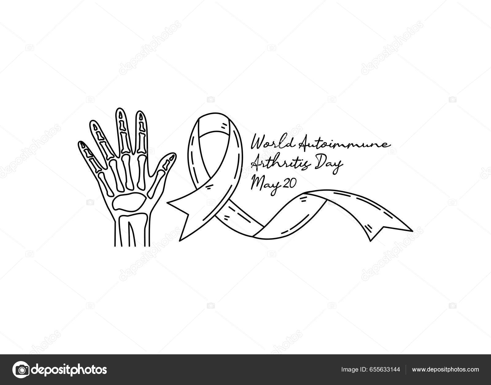 Arthritis Rheumatoid Deformity Deformities Hand Ulnar Valgus Hallux ...