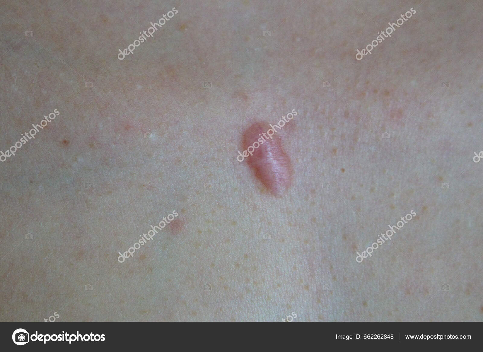 Tubercle Skin