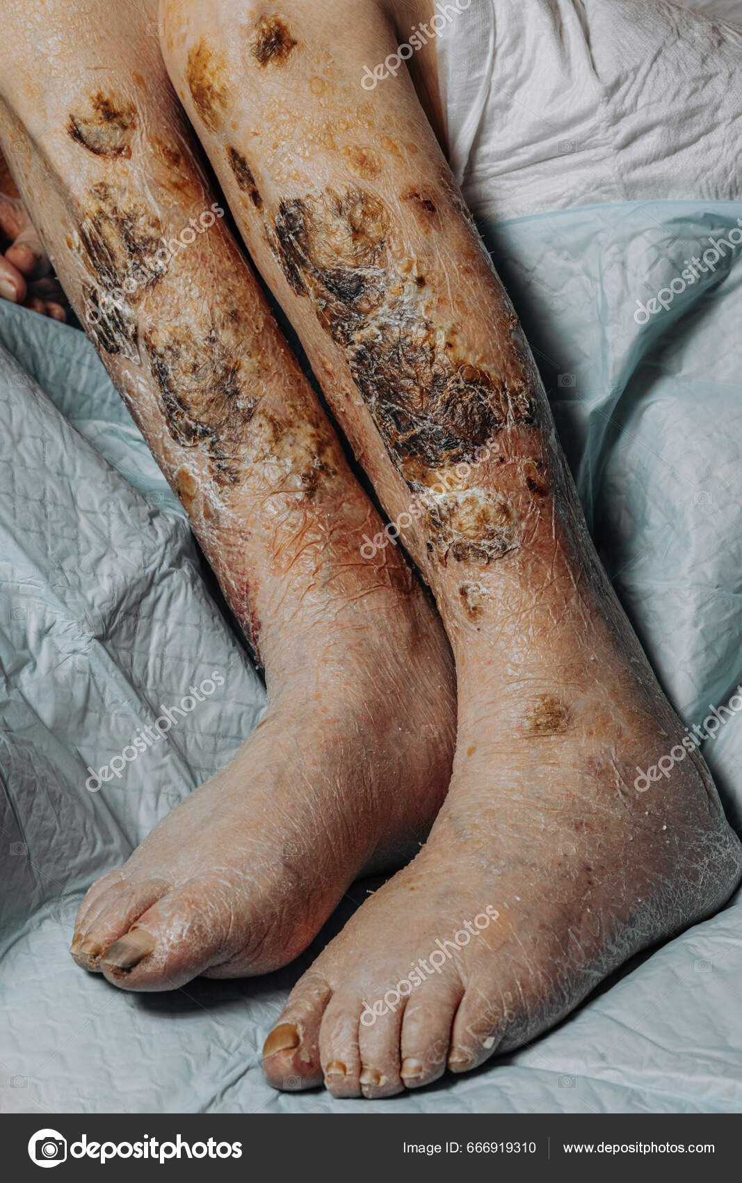 Skin Lesions Leg Symptoms Characteristic Elderly Begin Red Rash Small ...