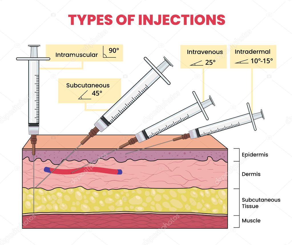 ilustración de los tipos de inyección infografía 2024