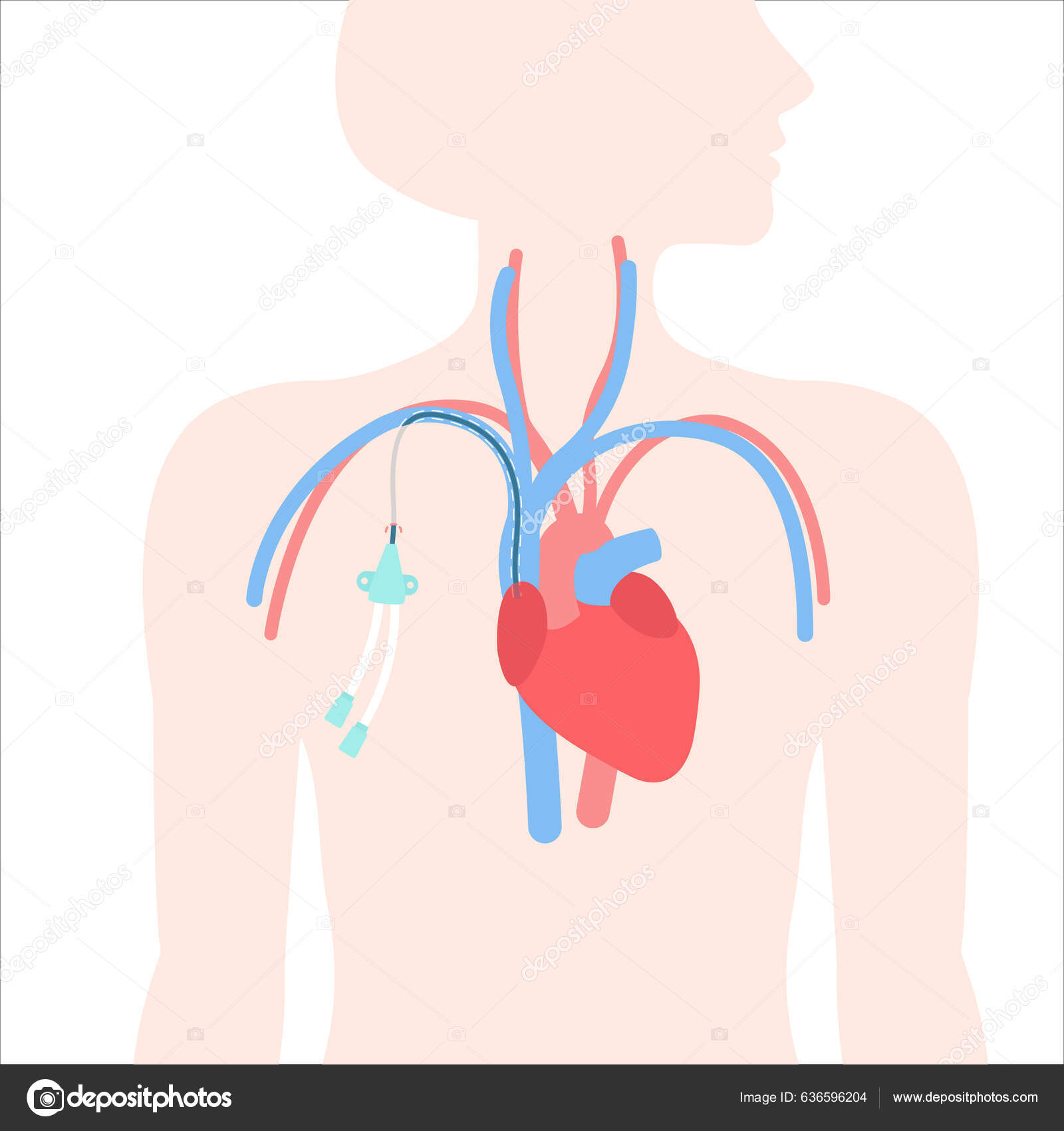 Cateter Venoso Central Tunelizado Colocado Veia Subclávia Paciente Com ...