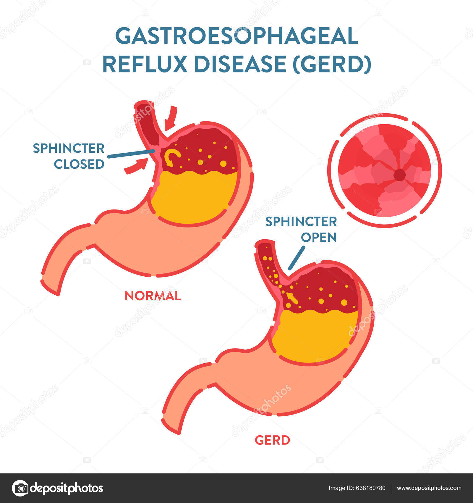 Gastroesophageal Reflux Disease Diagnostics Poster Endoscopic Image ...
