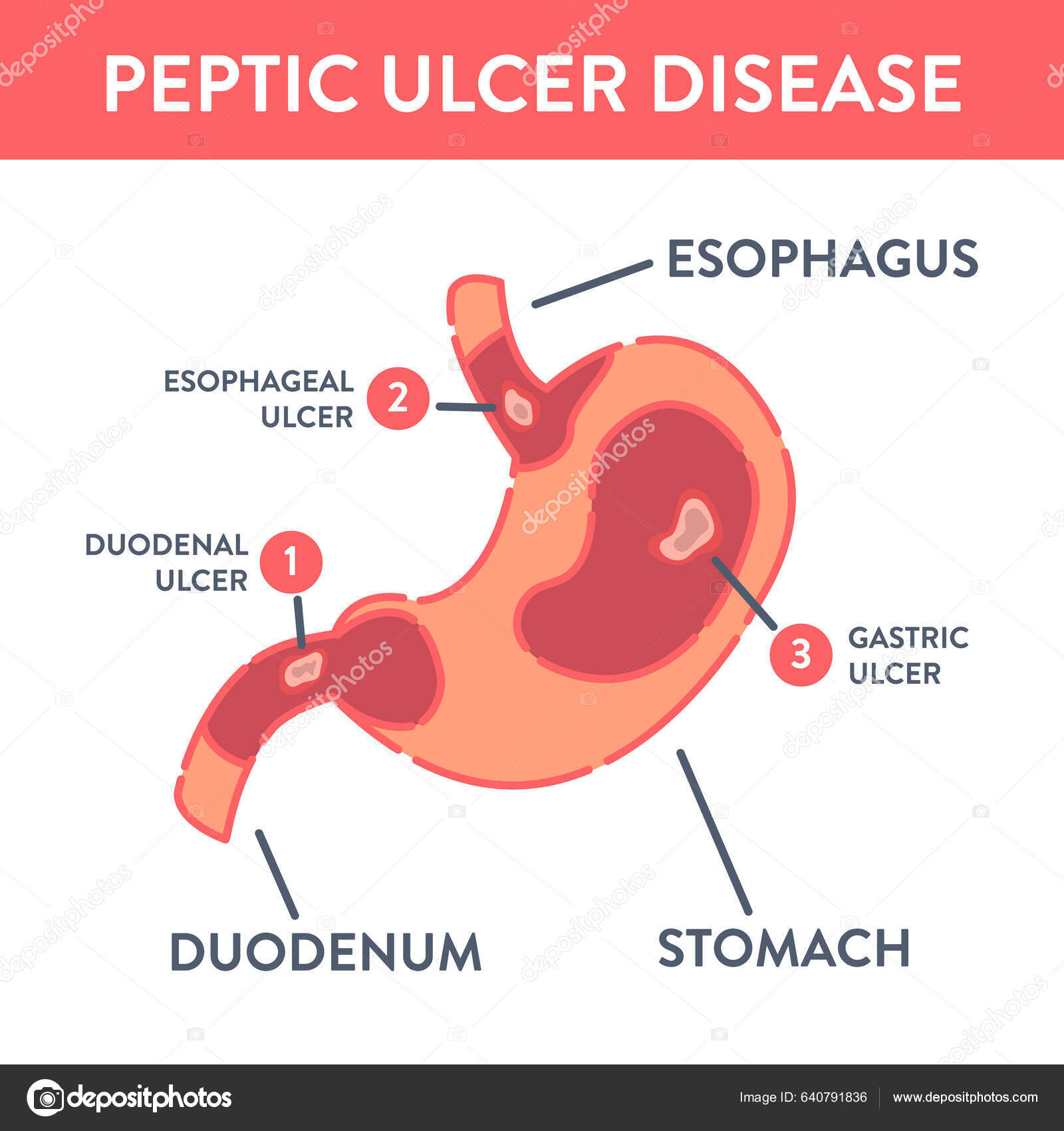 Ulcera Esofagica How To Treat Throat Ulcers: Symptoms & Home Remedies