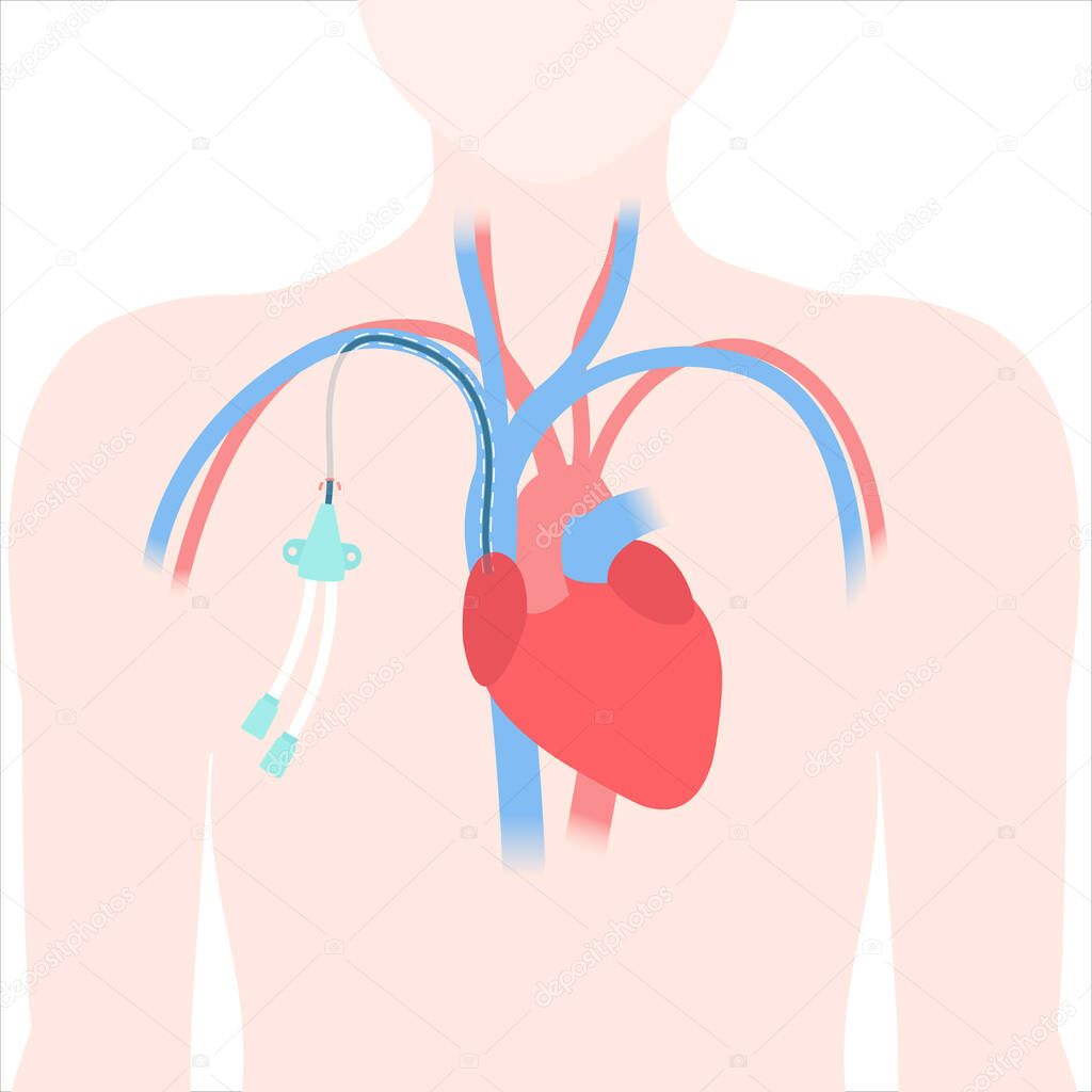 Catéter venoso central tunelizado colocado en la vena subclavia ...
