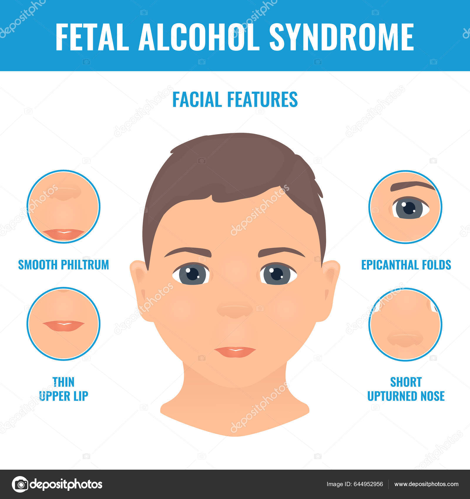 Facial Features Child Fetal Alcohol Syndrome Foetal Alcohol Spectrum ... Facial Features Child Fetal Alcohol Syndrome Foetal Alcohol Spectrum ...