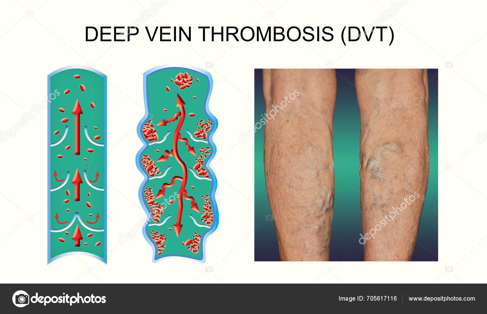 Deep Vein Thrombosis Blood Clots Embolus Structure Normal Varicose ...