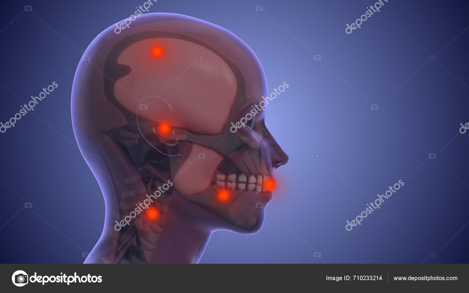 Referred Pain Muscle Trigger Points Masticatory Neck Shoulder — Stock ...