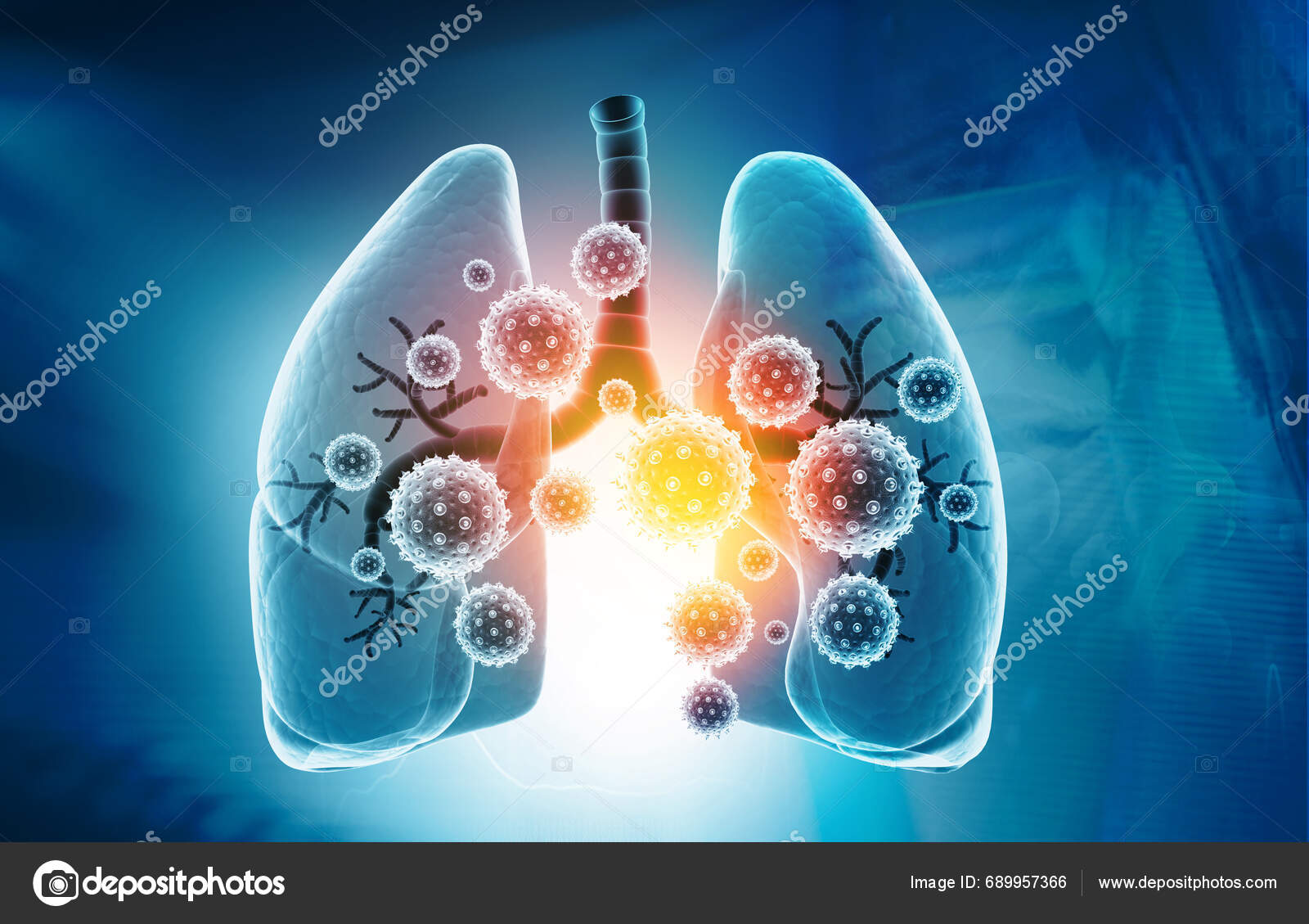 Infecciones Pulmonares Virales Infección Pulmonar Conservada ...