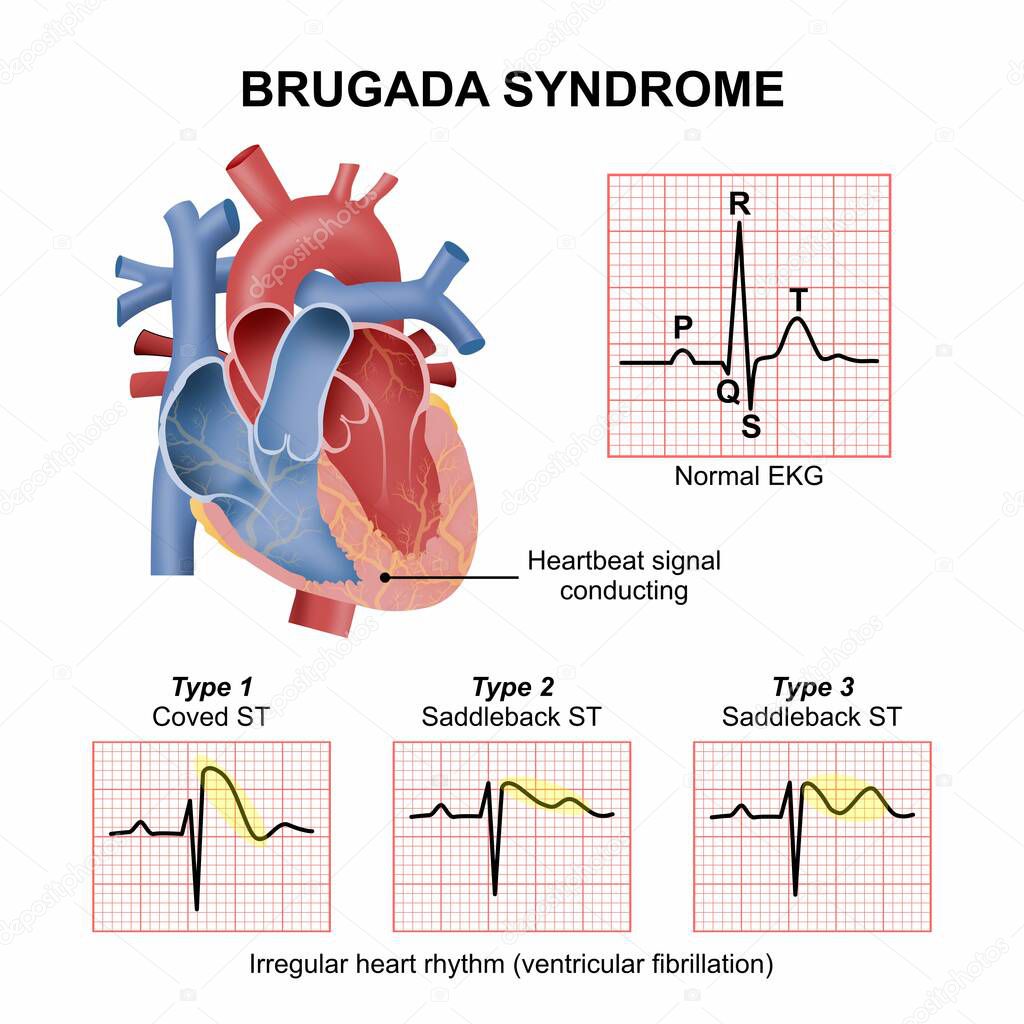 Síndrome de Brugada Frecuencia cardíaca Ilustración 2025